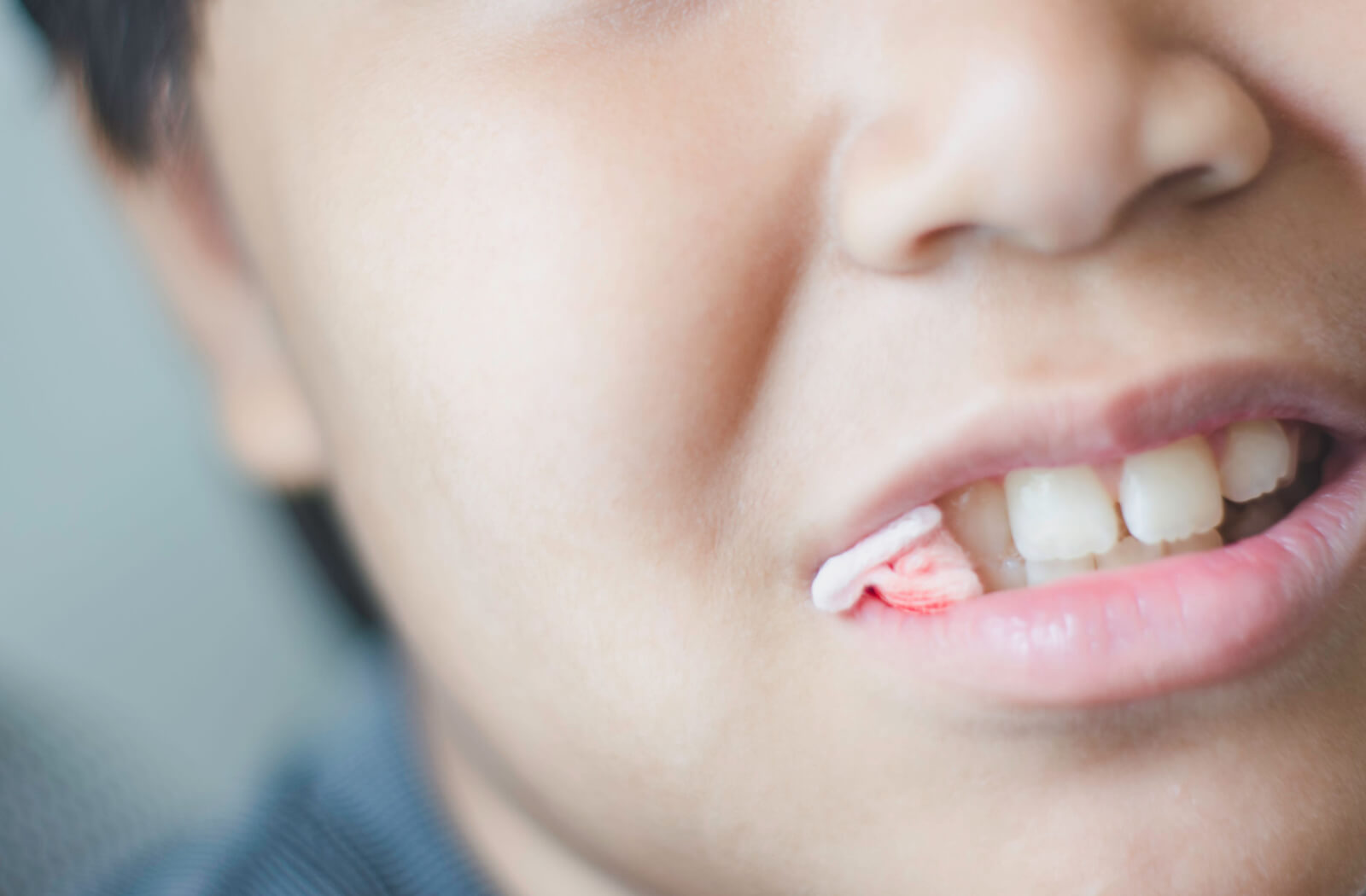 When To Stop Using Gauze After Tooth Extraction Okotoks When To Stop Using Gauze After Tooth Extraction Okotoks