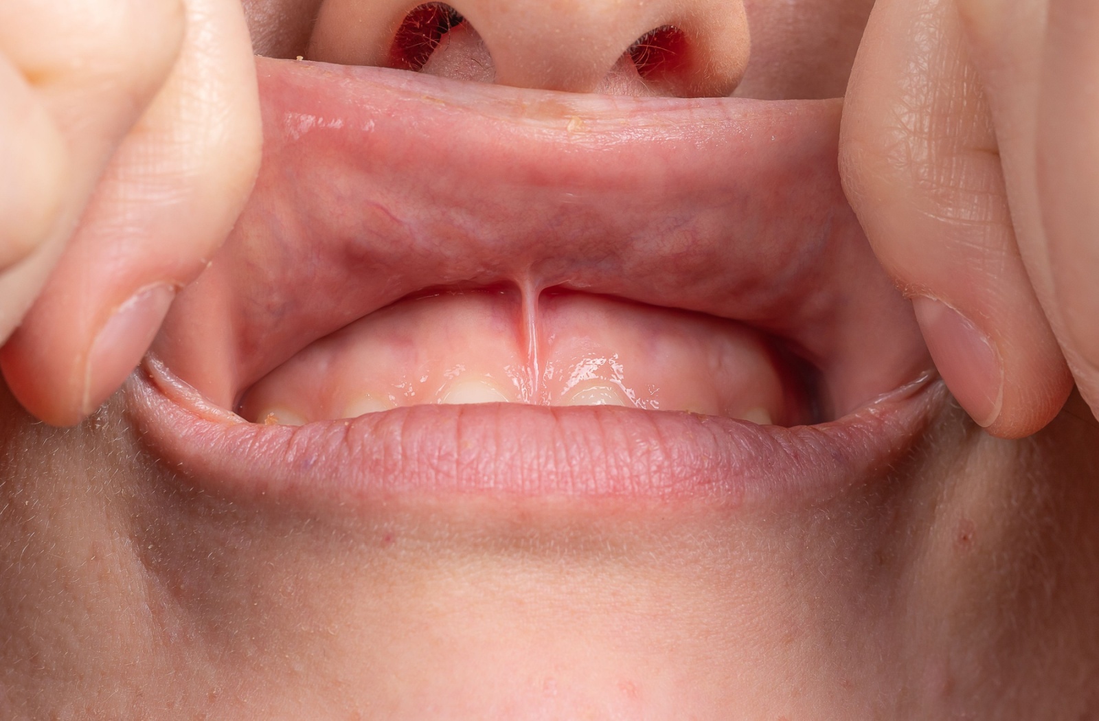 What Is a Frenectomy for Infants?